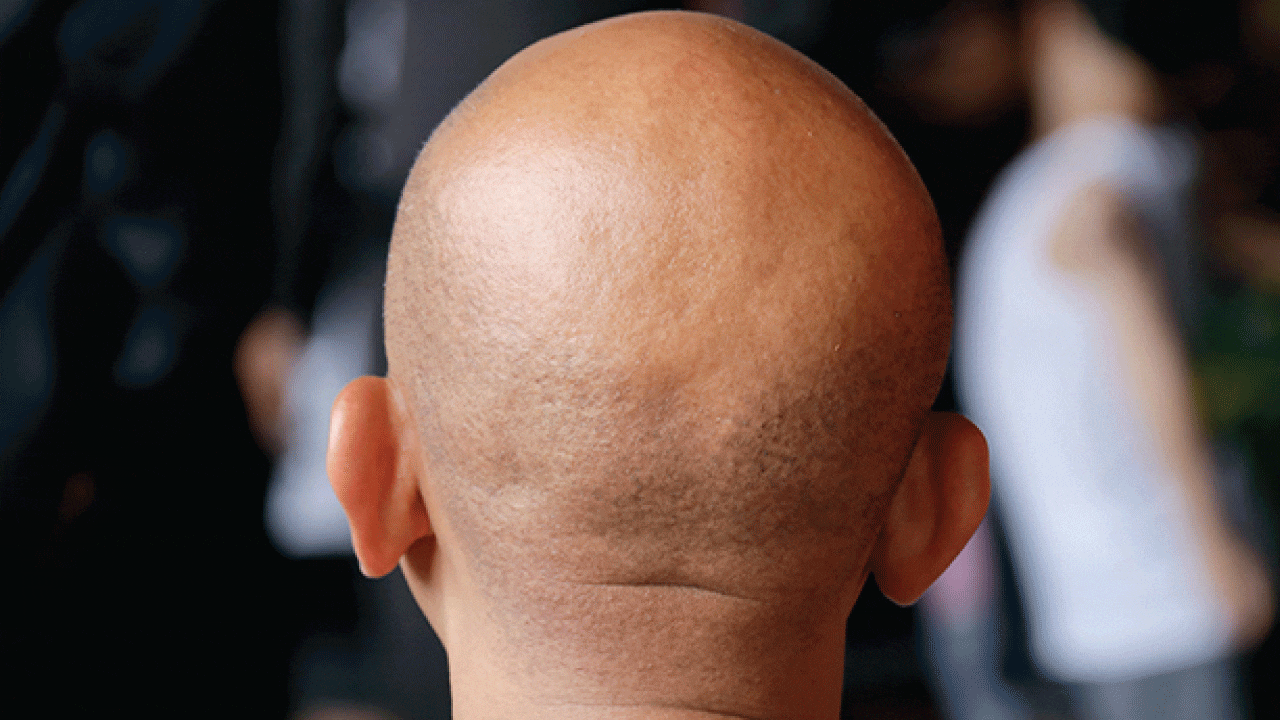 Pemakanan jadi faktor, ketahui negara paling ramai lelaki botak di dunia